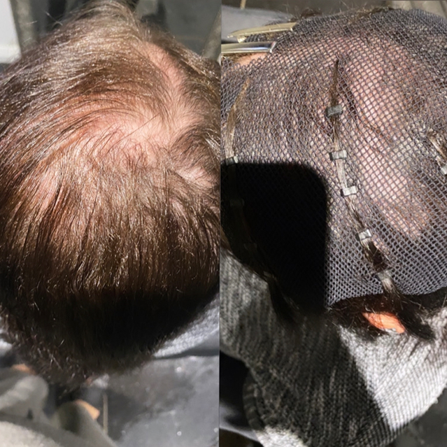 Mesh Integration For Thinning Caused By Pregnancy