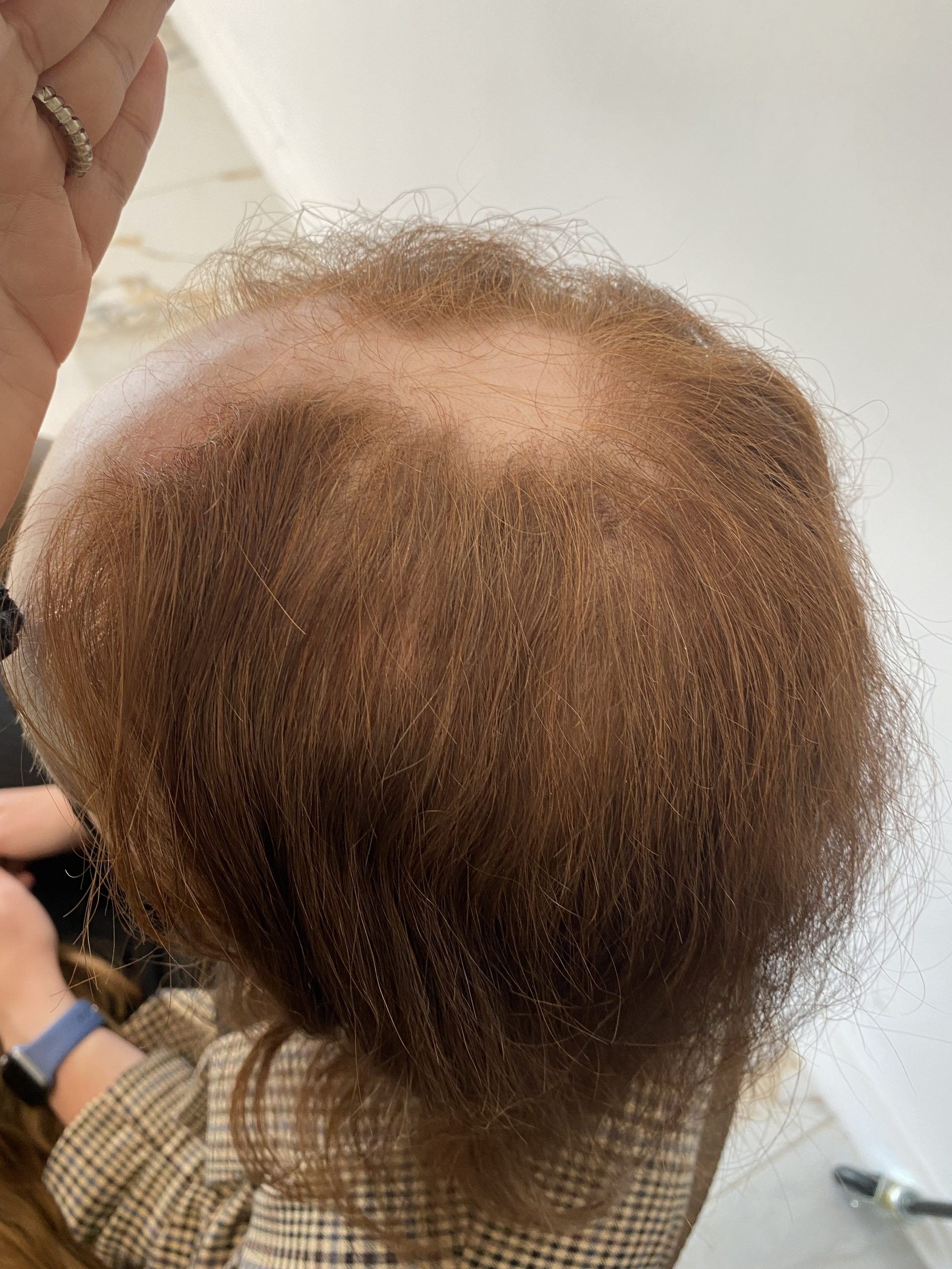 Hair Transformation Using A Mesh Integration System - Lacy Locks