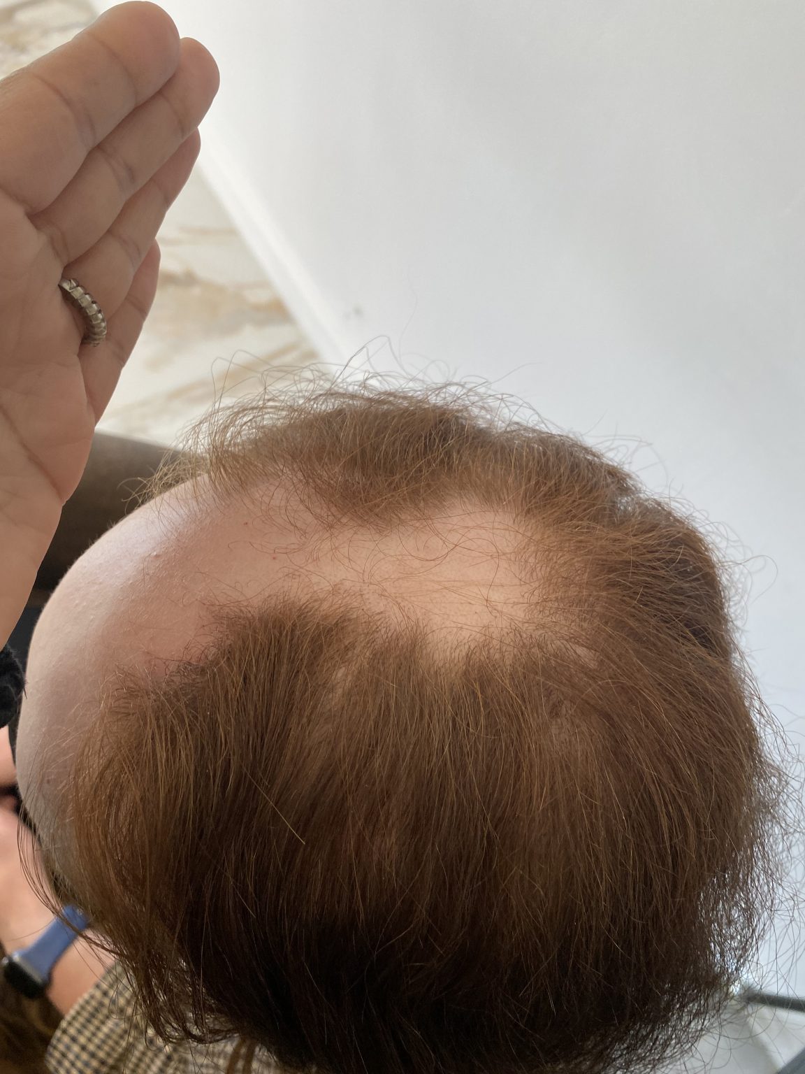 Hair Transformation Using A Mesh Integration System - Lacy Locks