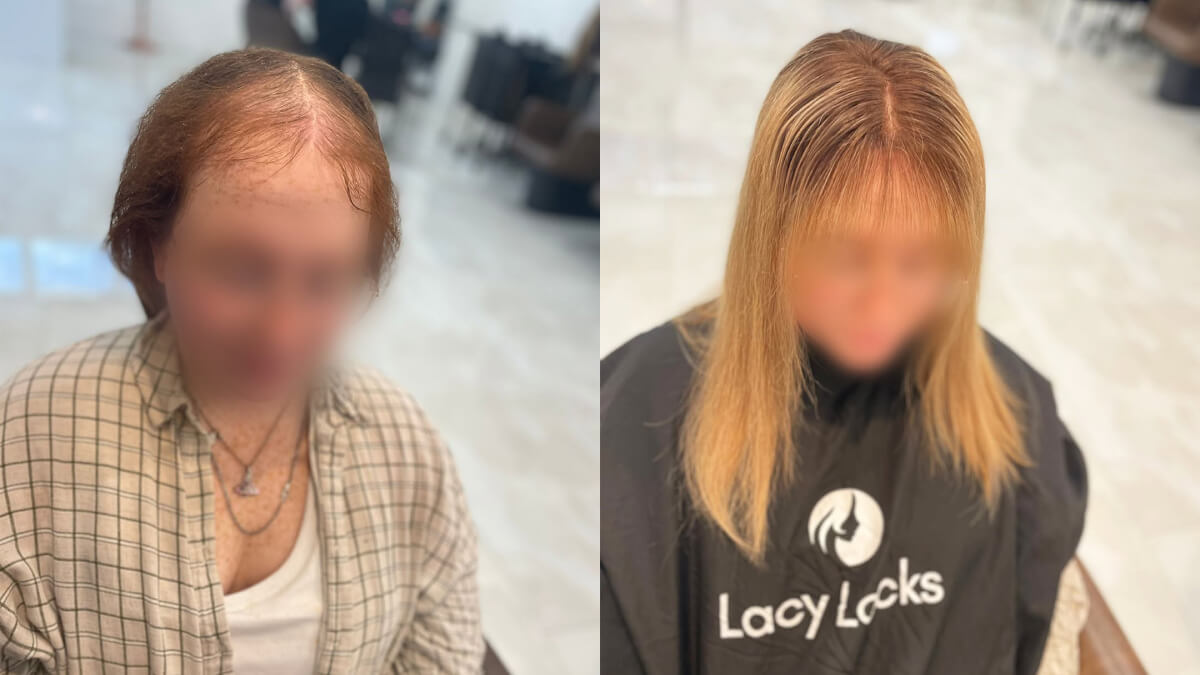 Hair Loss Solutions: What Is Mesh Integration?